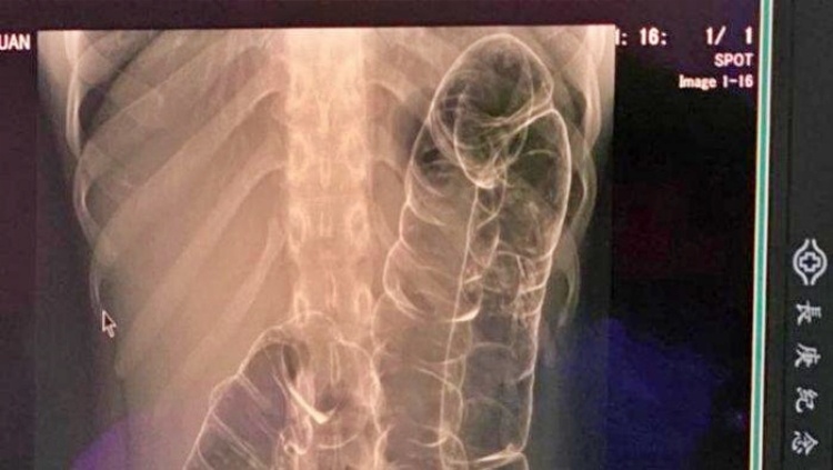 VIRAL !! Foto Rontgen UsusNaik Hingga Ke Dada, ini Faktanya - BorobudurNews