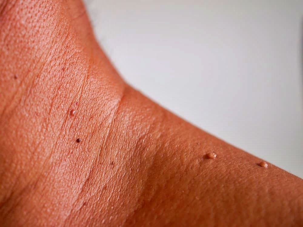 CERMATI !!! Gejala Skin Tag atau Daging Tumbuh Pada Kulit Manusia ...